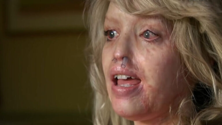 400 Surgeries Later: The Inspiring Story of Katie Piper's Recovery ...