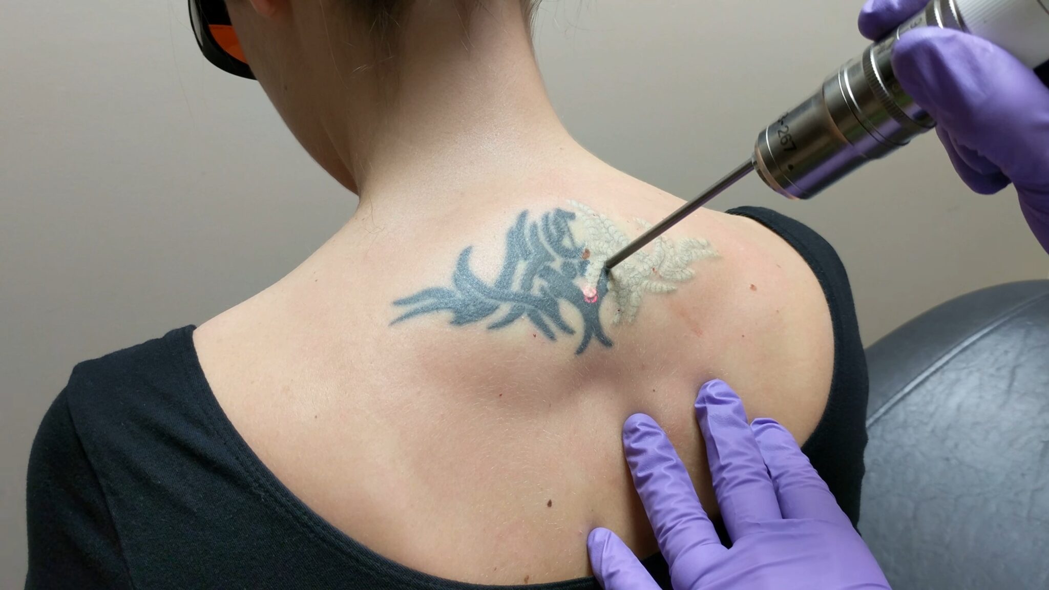 How Does Tattoo Removal Work? Tips for Understanding the Process - Wet ...